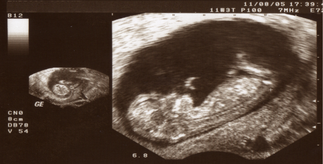 Deine 11. Schwangerschaftswoche